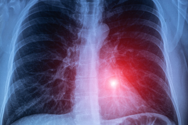 Tuberculosis (TB) Infection Testing and Treatments - Concentra
